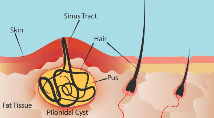 Can a Pilonidal Cyst Cause Bowel Problems? | American Chiropractors ...